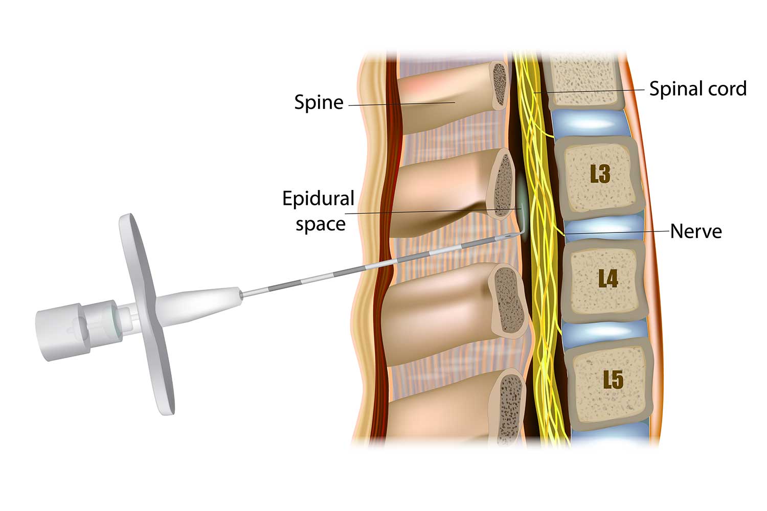Epidural Steroid Injections - GTI PAIN