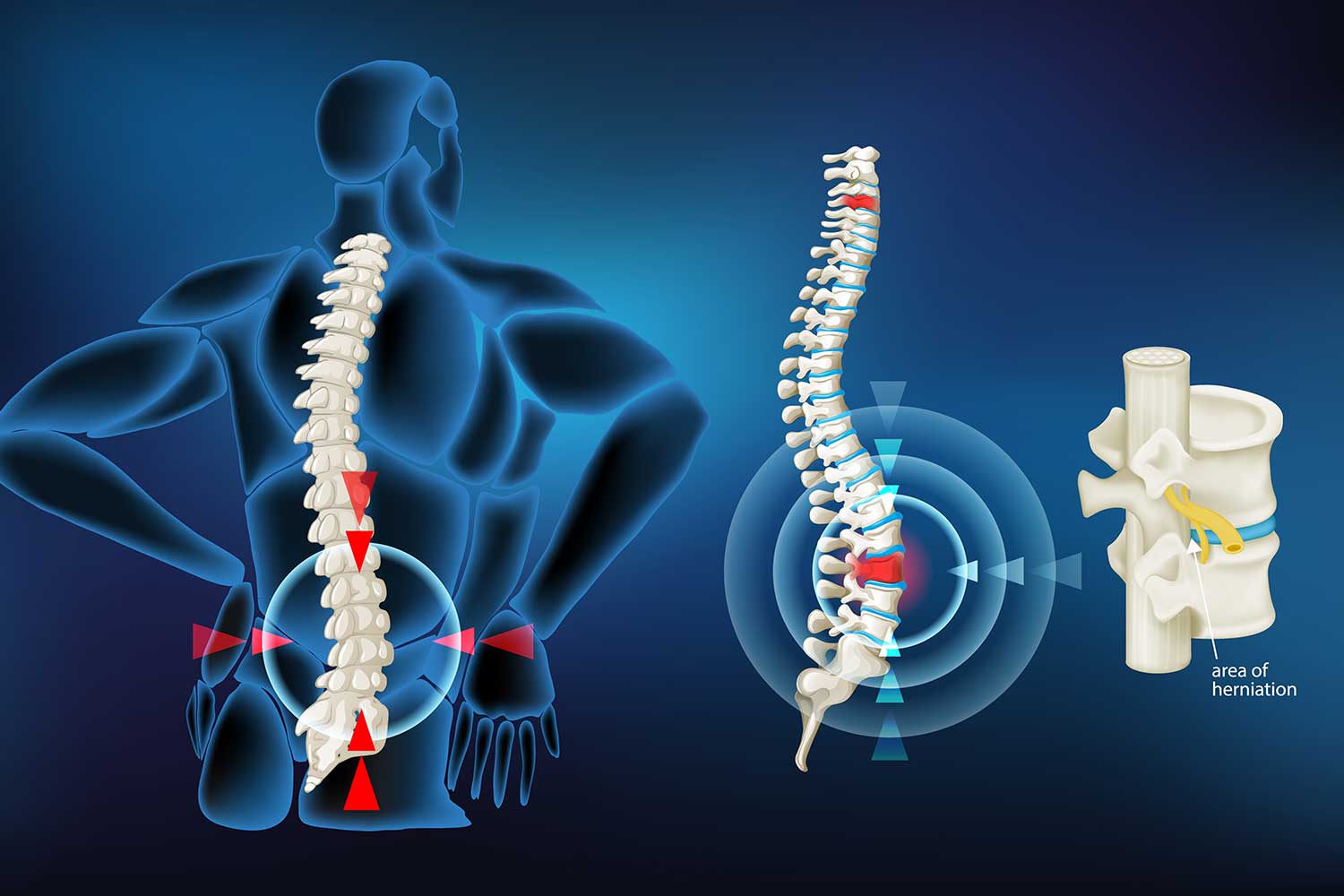 Transforaminal or Selective Nerve Root Block - GTI PAIN
